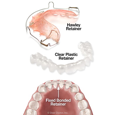 Retainer & After-Treatment Care | Edney Orthodontics