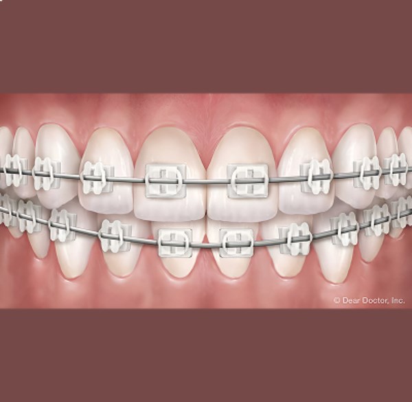 Effective Adult Orthodontic Treatment | Edney Orthodontics